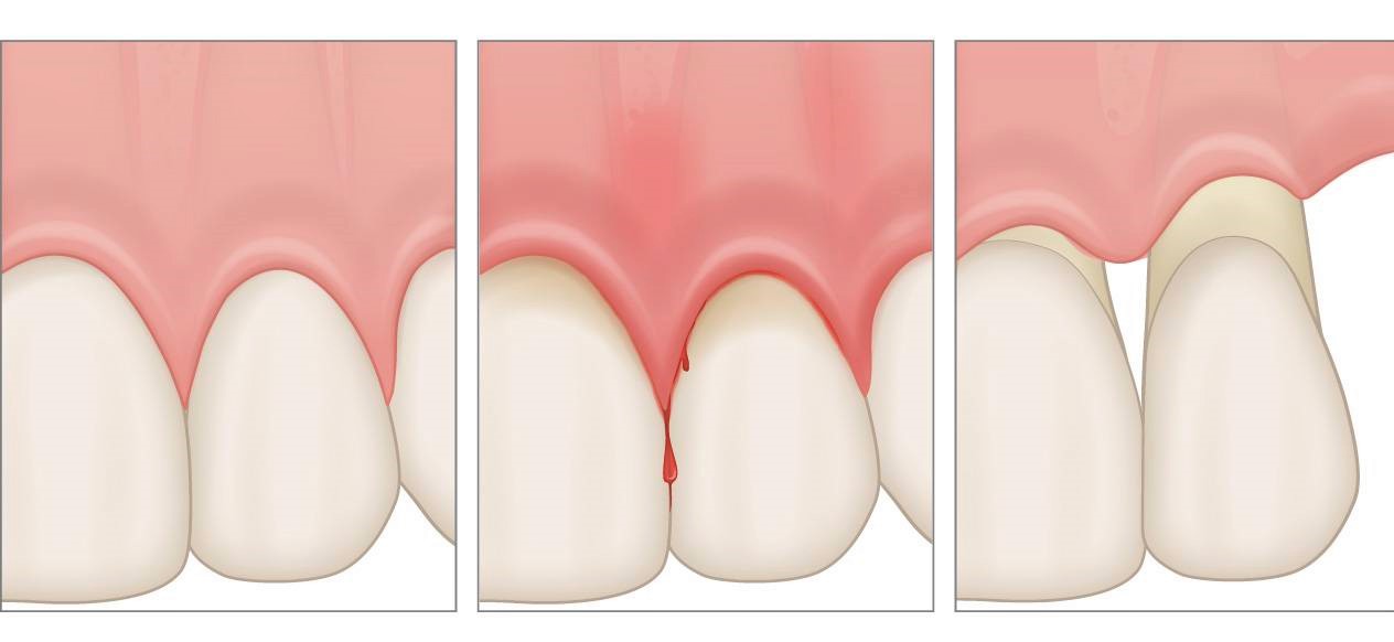Parodontoza - Light Dental Clinic